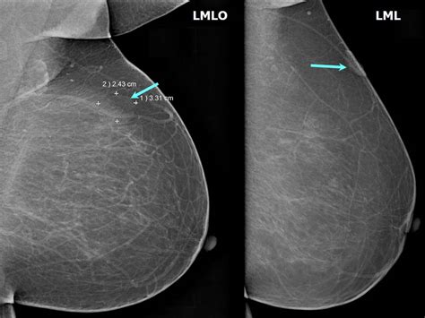 Atlas Of Breast Cancer Early Detection