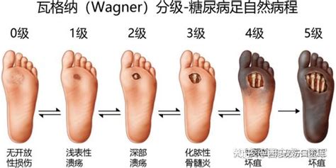 糖尿病足一般在什么情况下要截肢 知乎