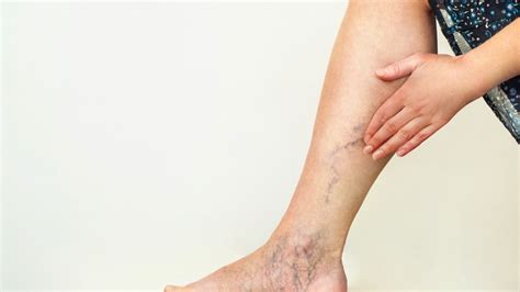 Varices quand les veines s emmêlent AlloDocteurs