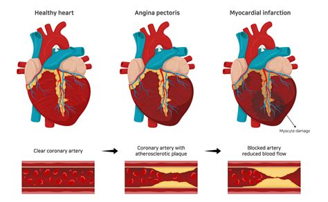 Heart Disease Hypertension High Blood Cholesterol Heart Disease