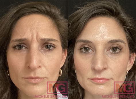 Top 6 Botox Forehead Before And After Hottest BSS News
