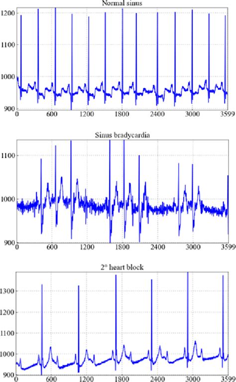 figure 2 from a comparative analysis of 2d deep cnn models for arrhythmia detection using stft