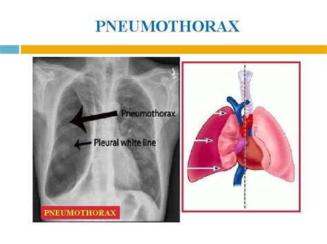 PLEURAL EFFUSION PYOTHORAX PNEUMOTHORAX Dr Sarika Gupta Asst