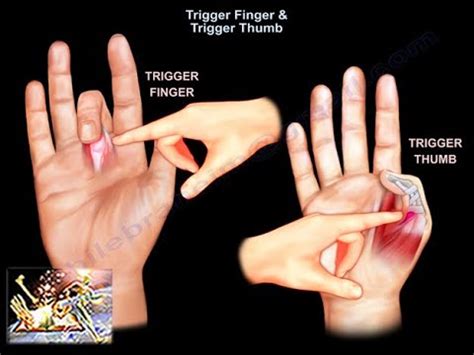 Trigger Finger Trigger Thumb Everything You Need To Know Dr