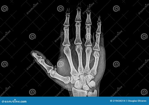 Imagen En Rayos X De La Mano Izquierda Muestra Fractura En Falanges Del