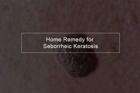 Can You Remove Seborrheic Keratosis At Home Stopyourskinproblem