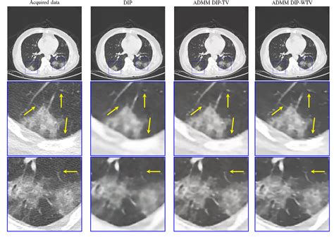 [pdf] combining weighted total variation and deep image prior for natural and medical image