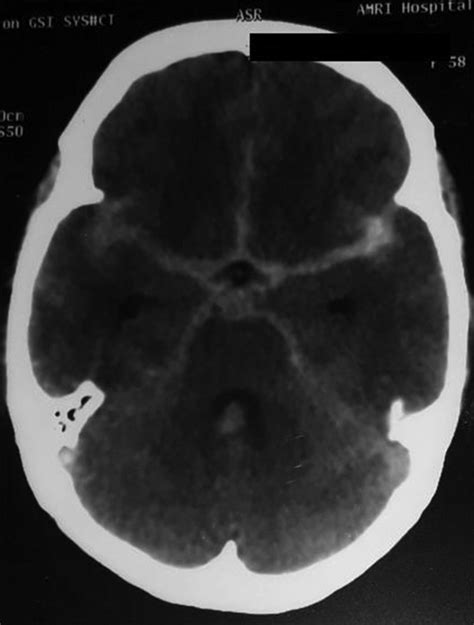 Computed Tomography Scan Showing Subarachnoid Bleed Figure 2 Computed
