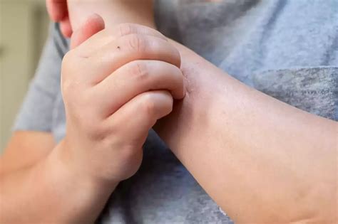Entenda O Que Herpes Zoster E Quais Os Principais Sintomas Da Doen A