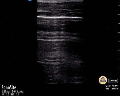 Peds Lung TPA