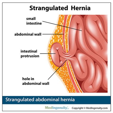 Treatments For Hernia And Hernia Surgery In Alaska Alaska Hernia Center
