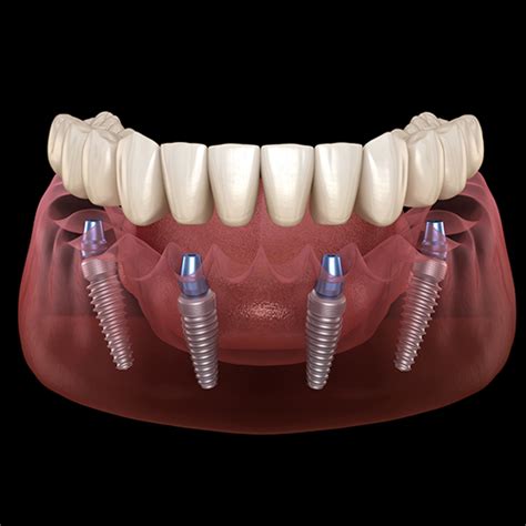Diferencias entre prótesis fija y removible Clínica Dental Barbieri