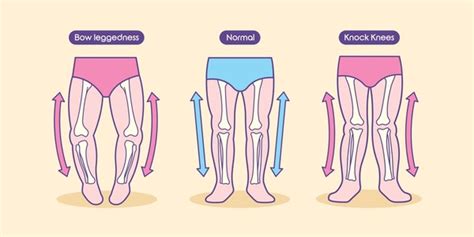 37 Baby Knock Knees Images Stock Photos 3D Objects Vectors