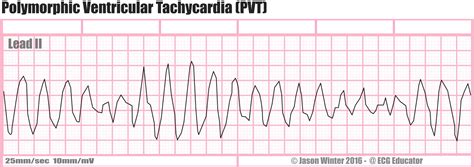 Matters Of The Heart V Tach PatMac RN