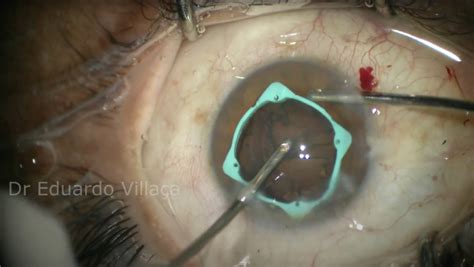 Facectomia Bilateral Centro Cir Rgico Bela Vista Cirurgia De Catarata