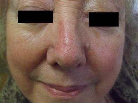 BCC Right Tip Of Nose Dr Vindy Ghura Dermatologist Manchester