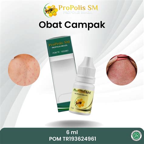 Jual Obat Campak Anak Dan Dewasa Penghilang Bekas Campak Campak Rubella