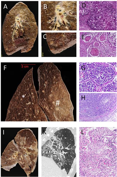 Illustrative Examples Of Postmortem Findings In The Lungs A E Case