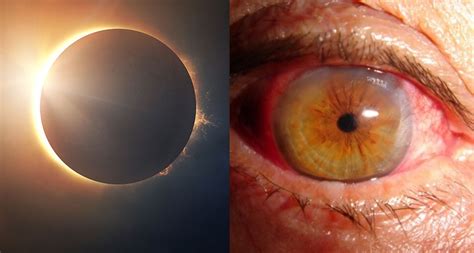 Cómo ver el eclipse solar y prevenir la retinopatía