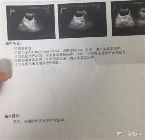 得了巧克力囊肿我自愈了亲身经历分享 知乎