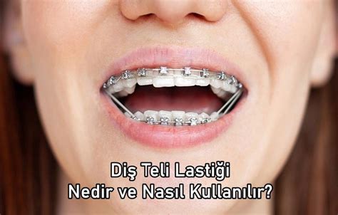 öncesi Ve Sonrası Diş Telleri