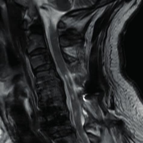Follow Up Magnetic Resonance Imaging Reveals The More Prominent Signal