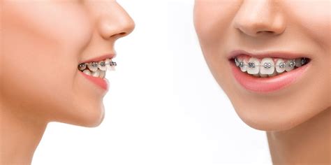7 fases del tratamiento de ortodoncia Clínica Dental Astigarraga