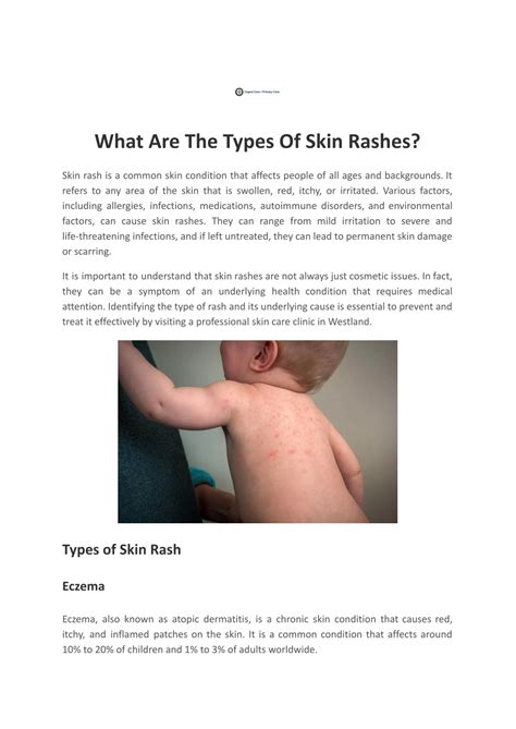 PPT What Are The Types Of Skin Rashes PowerPoint Presentation Free
