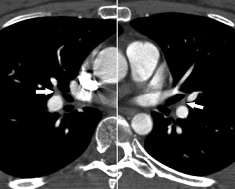 CT Angiography Of Pulmonary Embolism Diagnostic Criteria And Causes Of