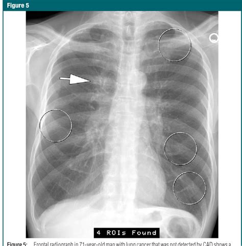 figure 5 from use of a computer aided detection system to detect missed lung cancer at chest