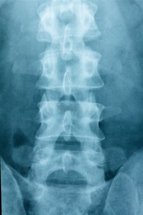 Espina Dorsal Lumbar Ap De La Radiograf A De La Pel Cula De La