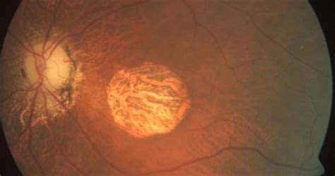 Understanding Geographic Atrophy Causes Symptoms Treatment And