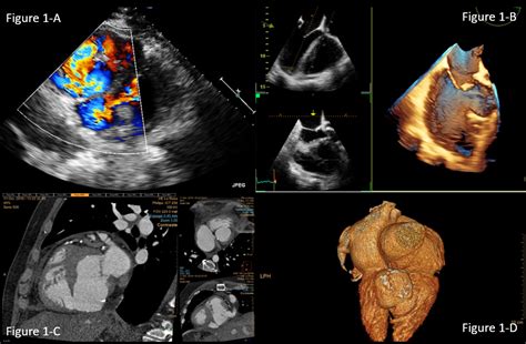 VENTRICULAR SEPTAL RUPTURE AND LEFT VENTRICULAR ANEURYSM IN A PATIENT