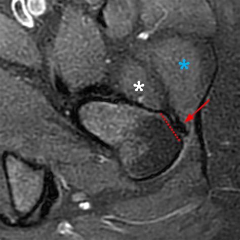 Gluteus Minimus Anatomy And Tear Patterns Radsource