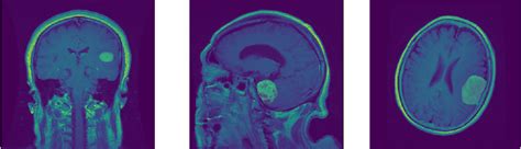 brain tumor segmentation