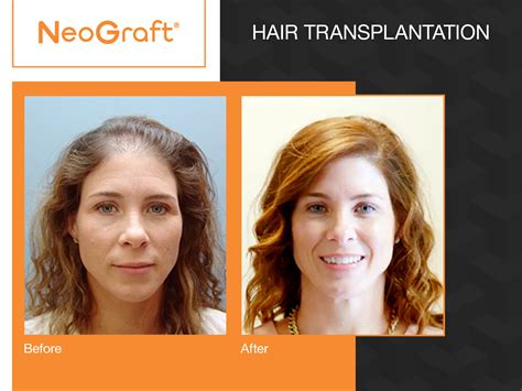 Neograft Nyc Long Island Neograft Treatment