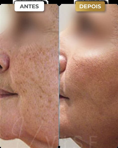 Laser Lavieen Vitalise Locação de Ultraformer