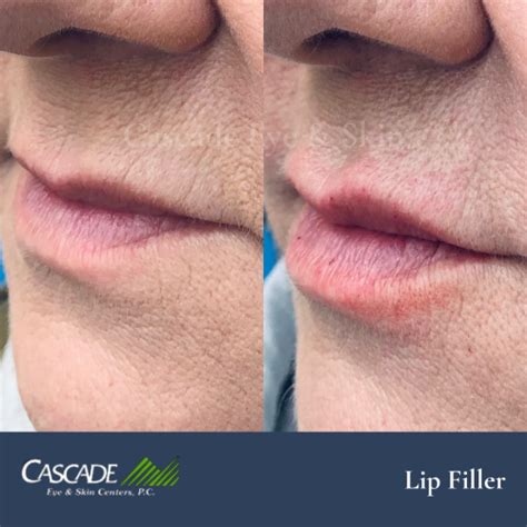 Injectable Dermal Fillers Cascade Eye Skin Centers