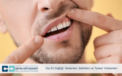 Diş Eti Sağlığı Nedenleri Belirtileri ve Tedavi Yöntemleri Sayın
