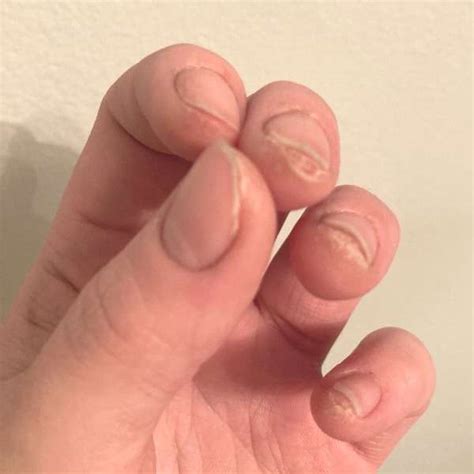 How I Got A Painful Allergic Reaction To Gel Polish From A UV Nail Lamp