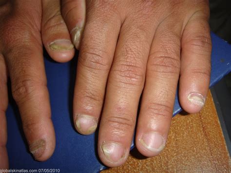 Global Skin Atlas Diagnosis Detail