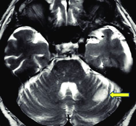 T2 Weighted Magnetic Resonance Imaging Showing Infarction Yellow Arrow