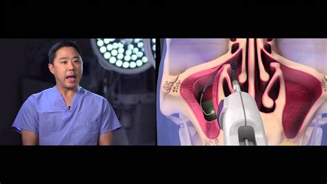 Balloon Sinuplasty In Office Procedure YouTube