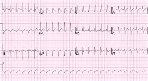 Dr Smith S ECG Blog January 2014