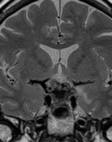 Radiology Of The Pituitary Endotext NCBI Bookshelf