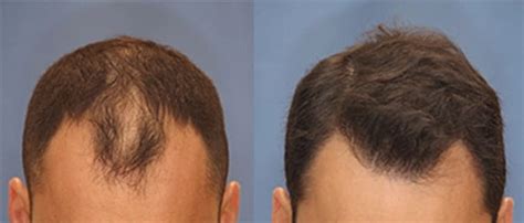 Hair Transplant Vs Plugs The Guide Burbank Hair Transplant