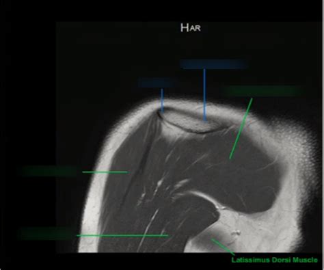 Coronal Shoulder Diagram Quizlet