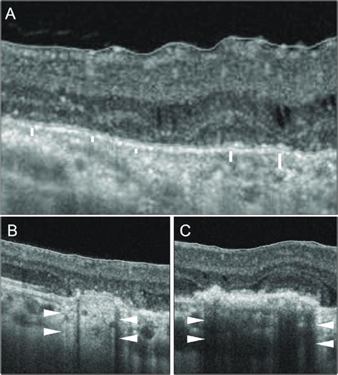 Optical Coherence Tomography OCT Scans Of Different Patients With