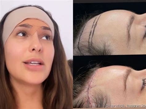 Ex Bbb Tha S Braz Faz Cirurgia Para Diminuir Tamanho De Testa Jd