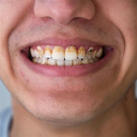 Lista 103 Foto Como Quitar El Sarro De Los Dientes De Mi Perro El último